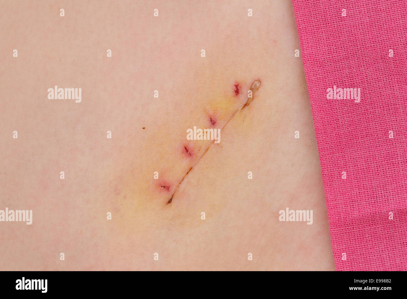 Appendicitis Scar High Resolution Stock Photography and Images - Alamy