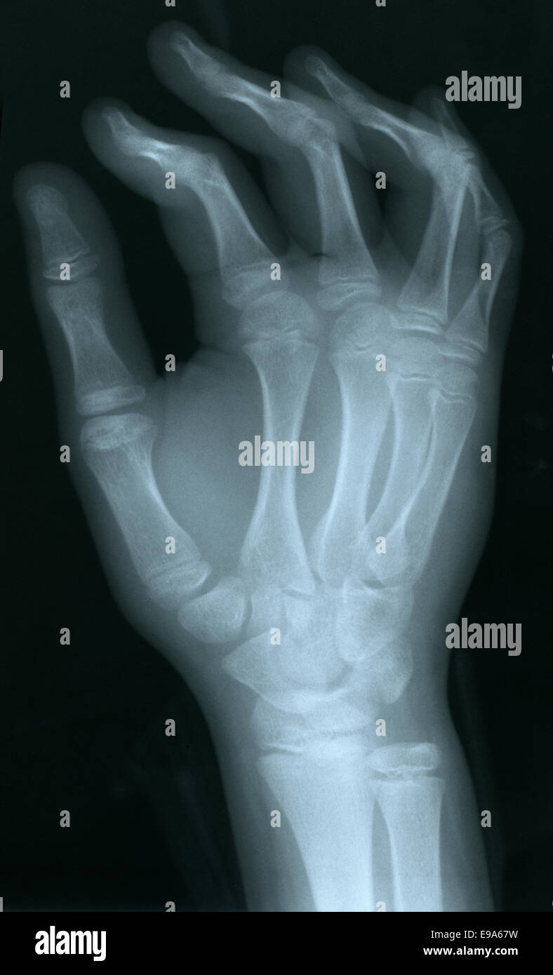 Human x ray hi-res stock photography and images - Alamy