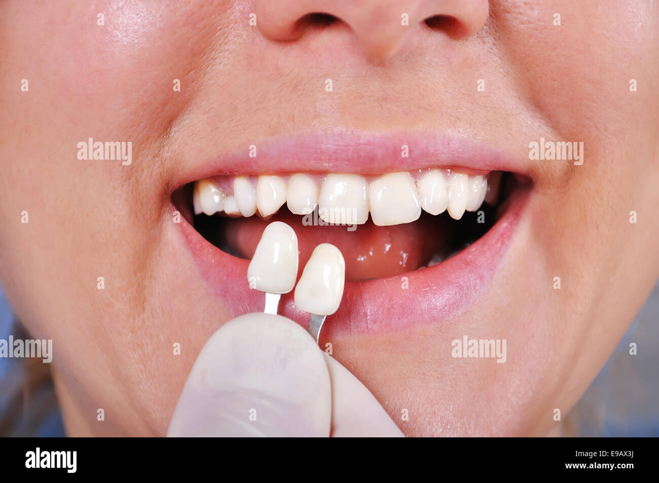 Dental sample hi-res stock photography and images - Alamy