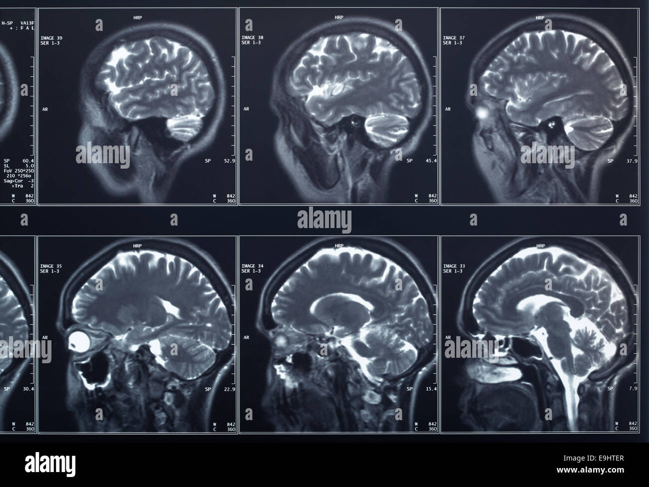 X-ray head and brain radiography Stock Photo - Alamy
