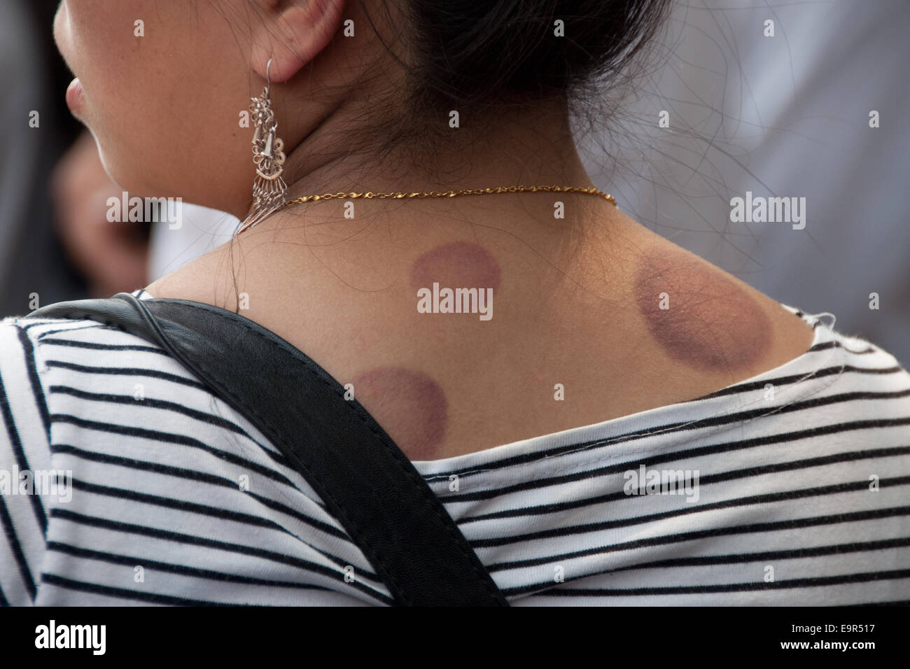 Cupping therapy hi-res stock photography and images - Alamy