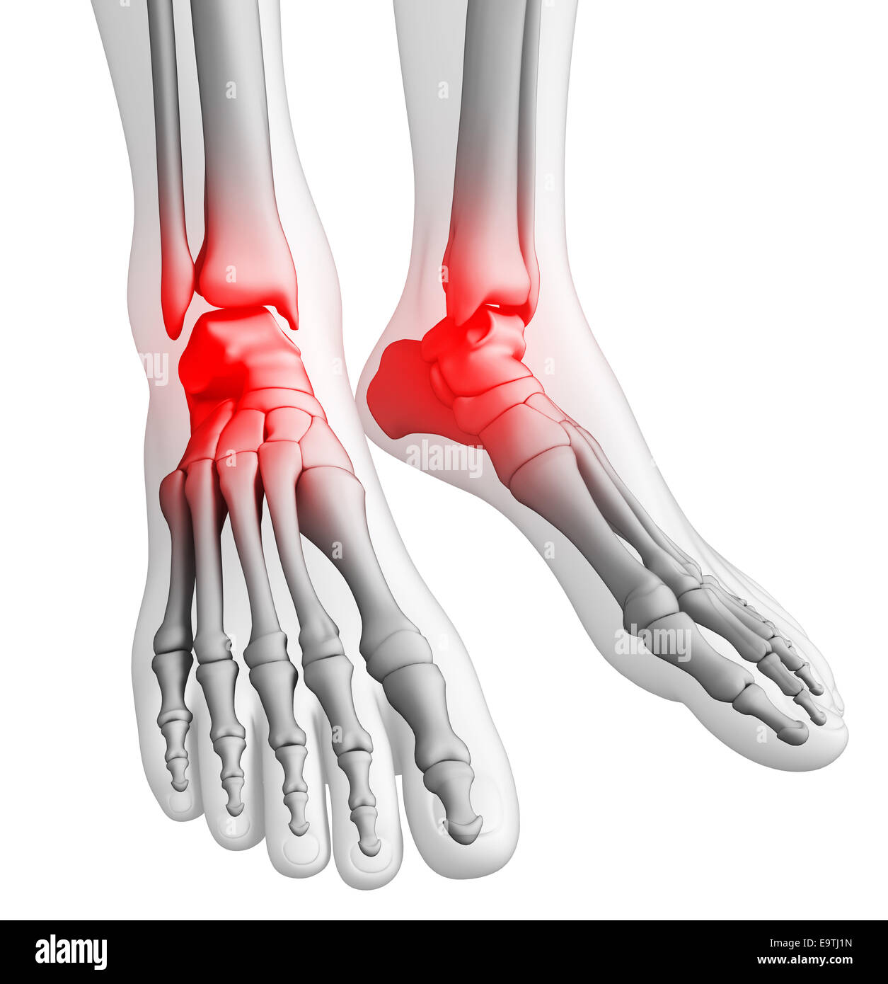 Illustration of foot pain artwork Stock Photo - Alamy