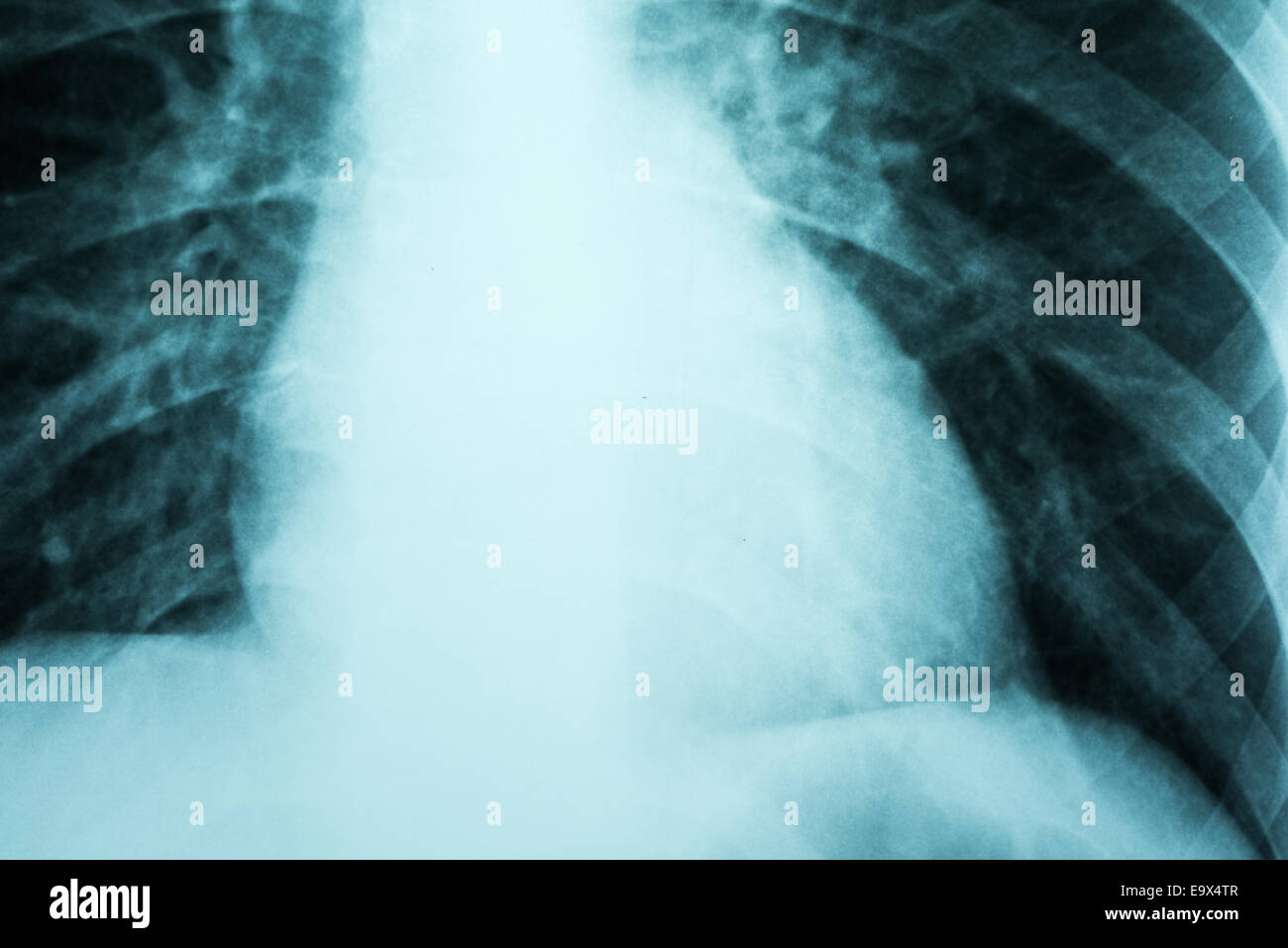 Cardiology X-Ray Of Patient Heart Stock Photo - Alamy