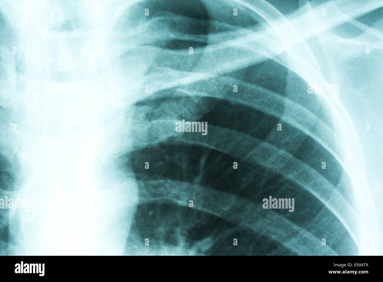 Xray Of Ribs What Does The Doctor Say