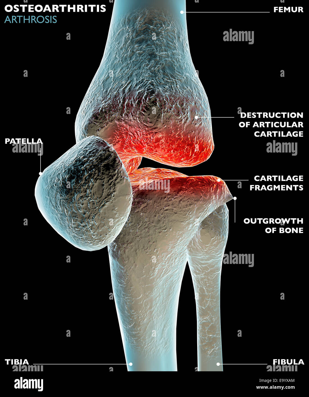 Human Femur Leg Bone Pain Stock Photo Alamy Human Femur Leg Bone Pain Stock Photo Alamy