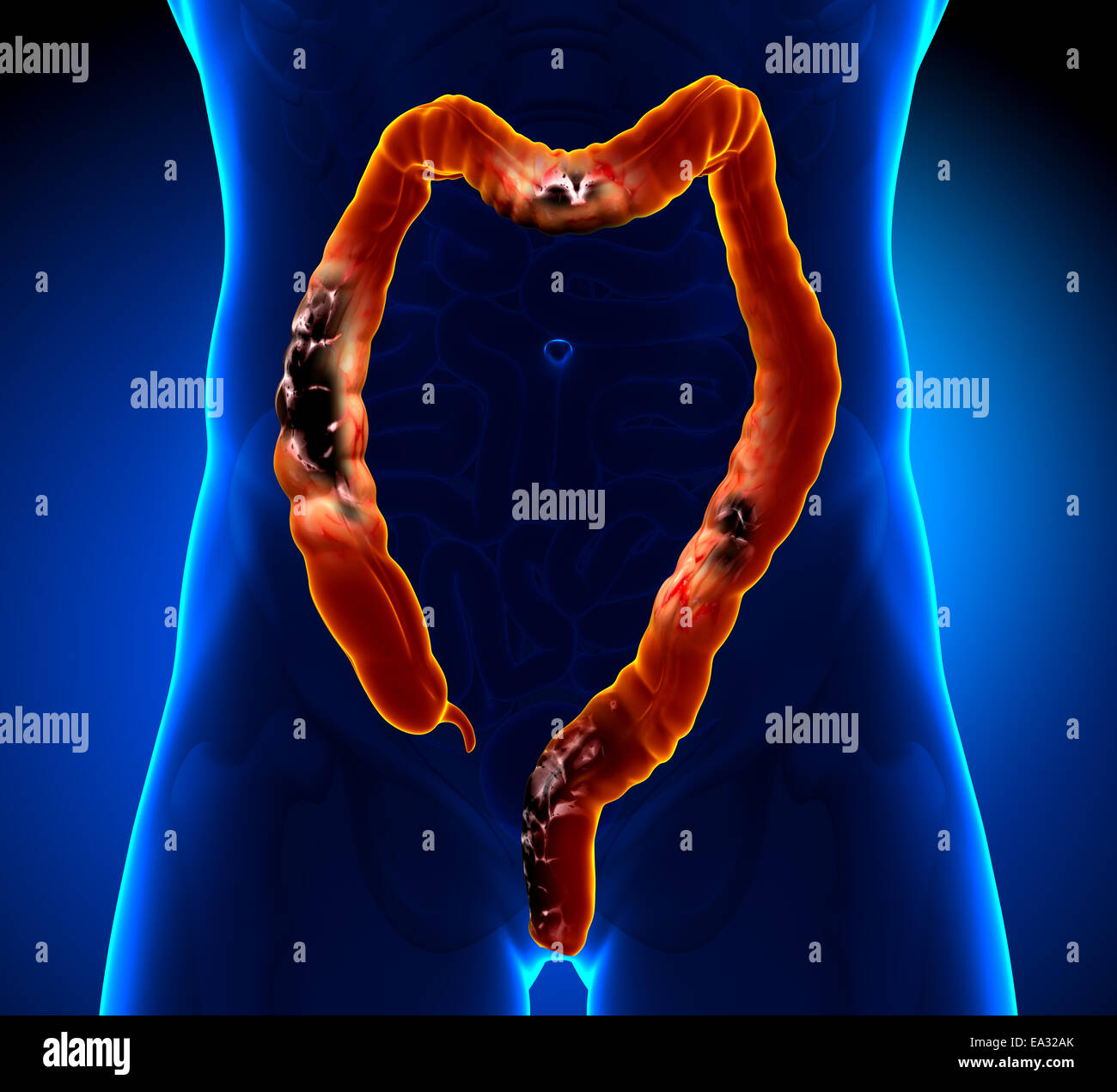 Intestinal polyps disease hi-res stock photography and images - Alamy