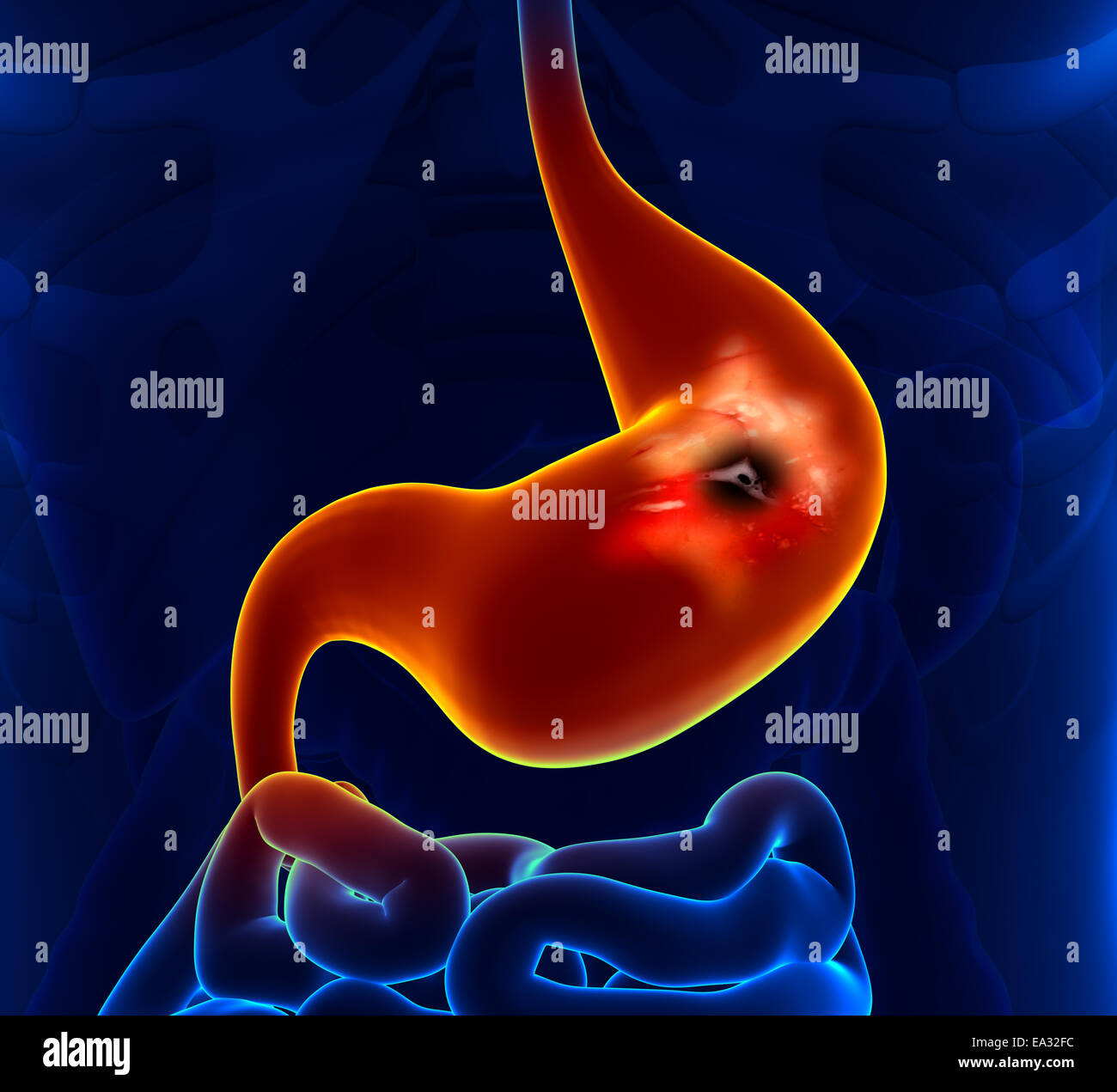 Esophagus Cancer Stock Photos & Esophagus Cancer Stock Images - Alamy
