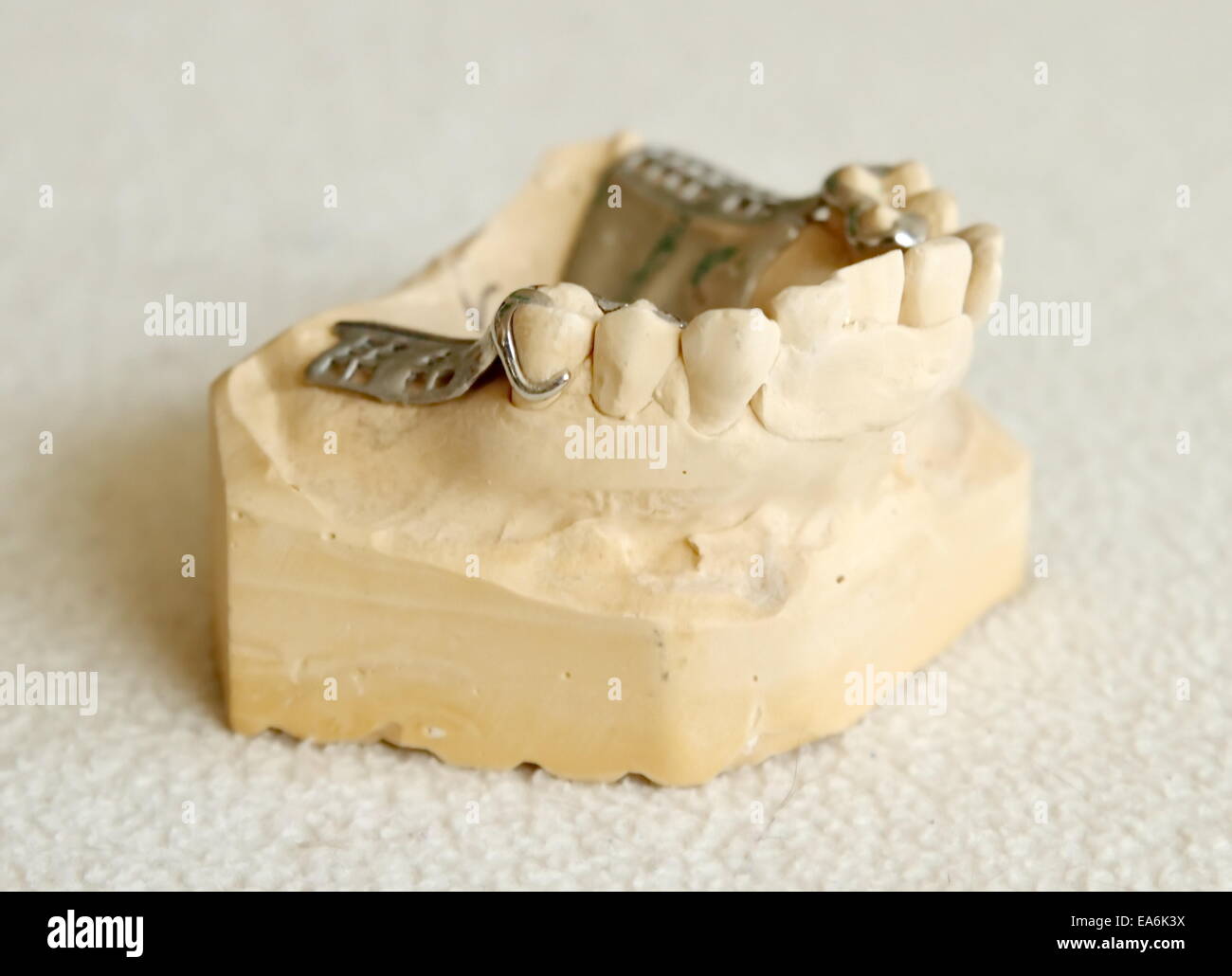 Denture framework cast hi-res stock photography and images - Alamy