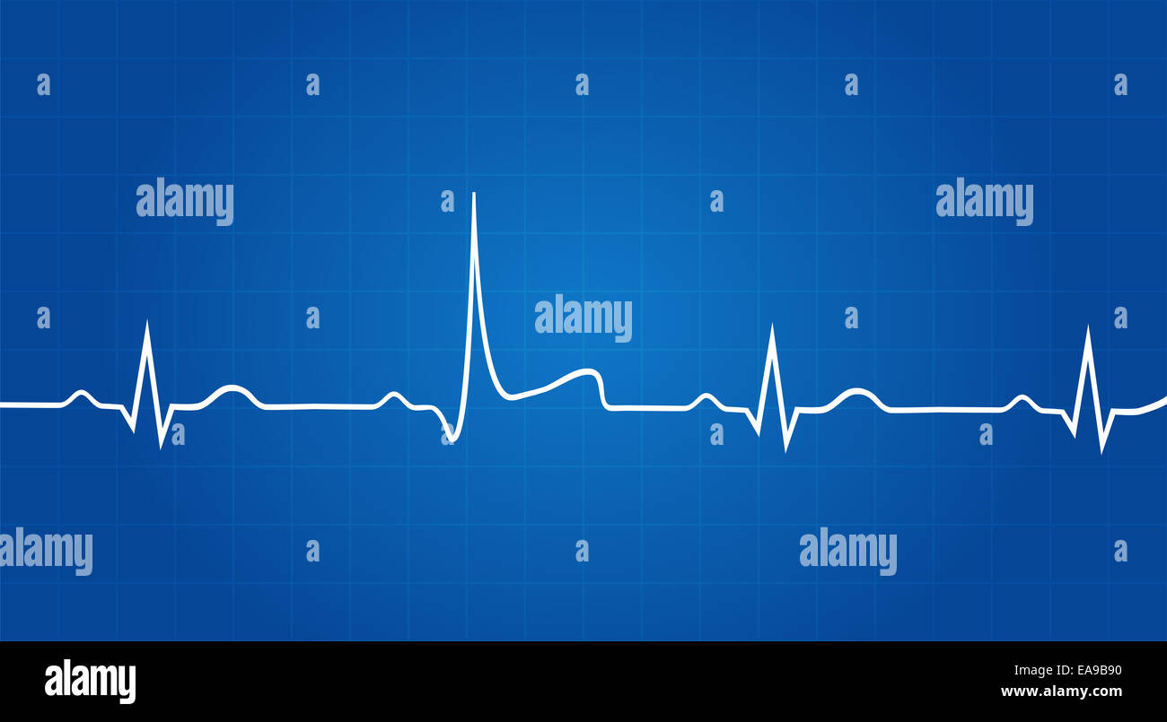 Heart Attack Ecg Line Graphics Medical Electrocardiogram Stock