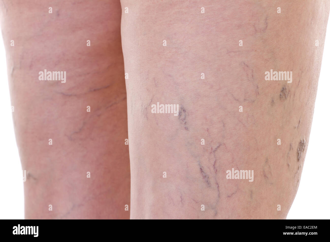 Close-up of legs with varicose veins Stock Photo - Alamy