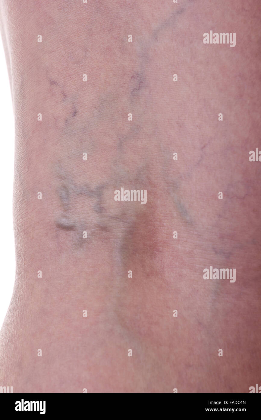 Anatomy of the leg veins hi-res stock photography and images - Alamy