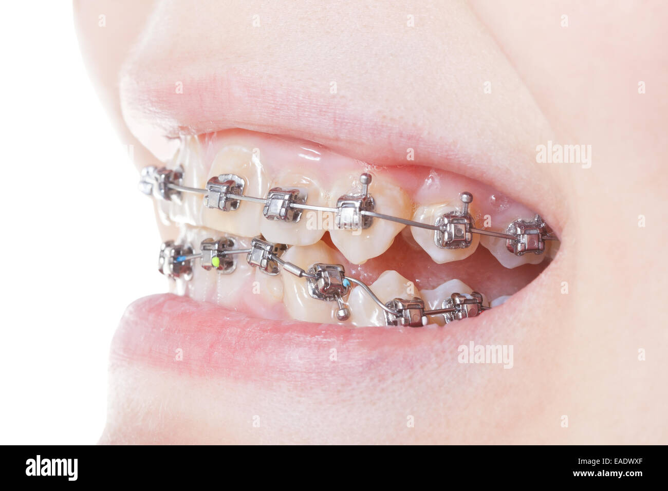 side view of dental braces on teeth close up during orthodontic ...