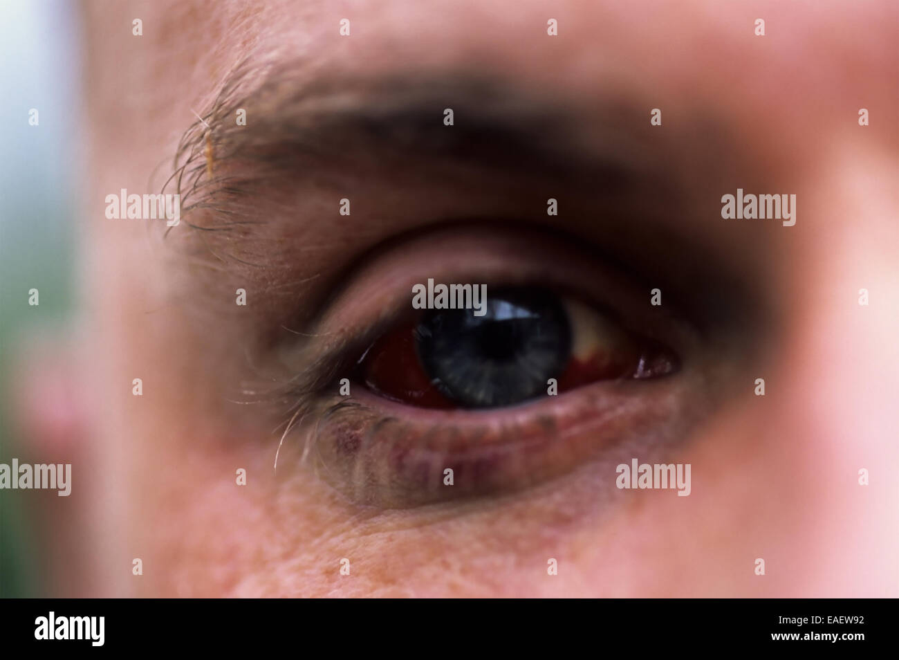 Scuba Diving Barotrauma Injury Stock Photo - Alamy