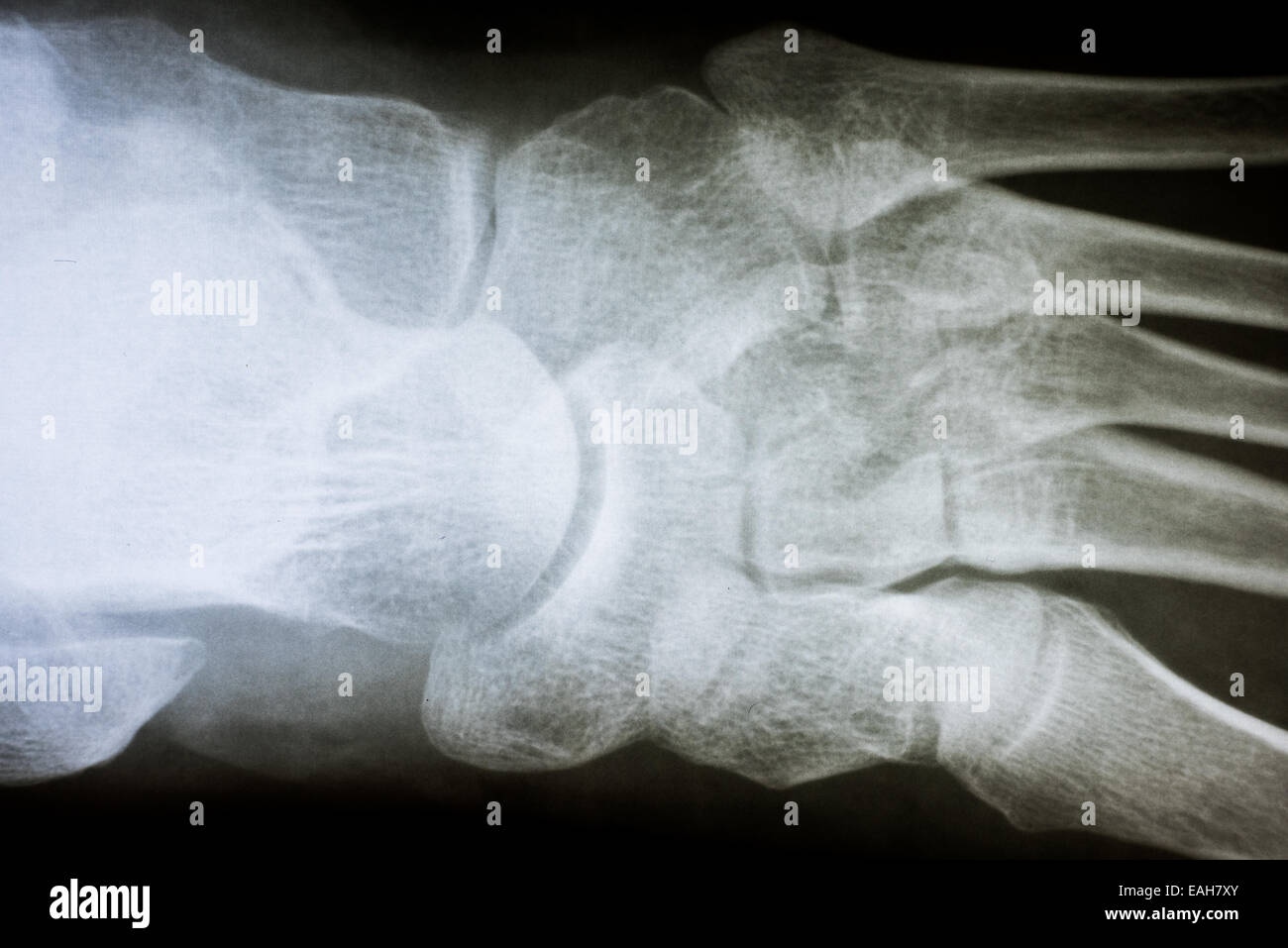 Human Foot X-Ray On Black Background Stock Photo - Alamy
