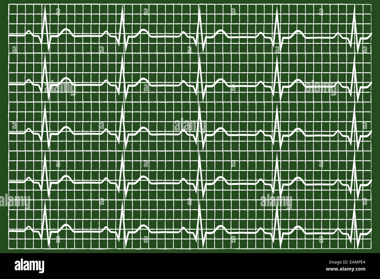 Normal Electrocardiogram Graphic Explained On Blackboard Stock Photo ...