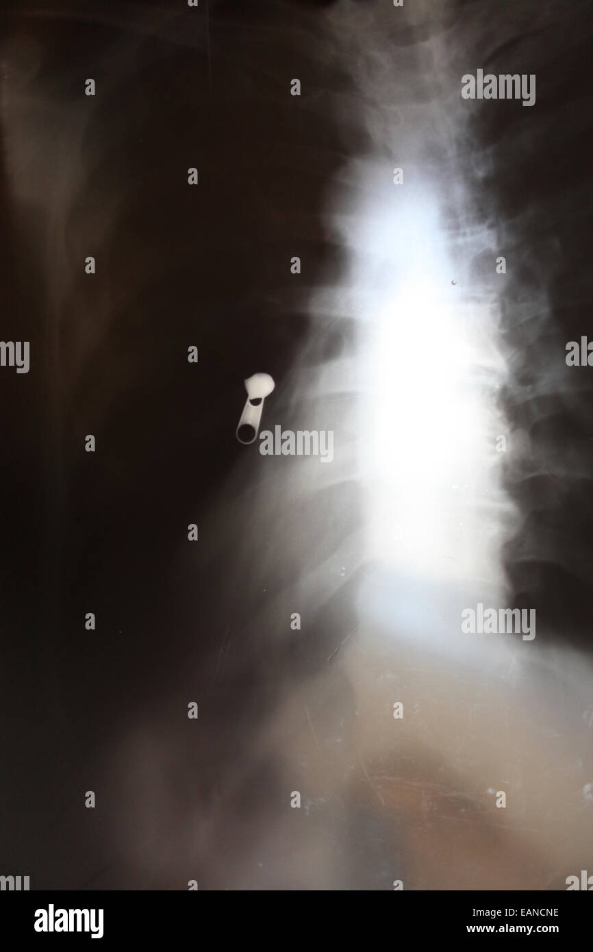 Broken spine x ray hi-res stock photography and images - Alamy