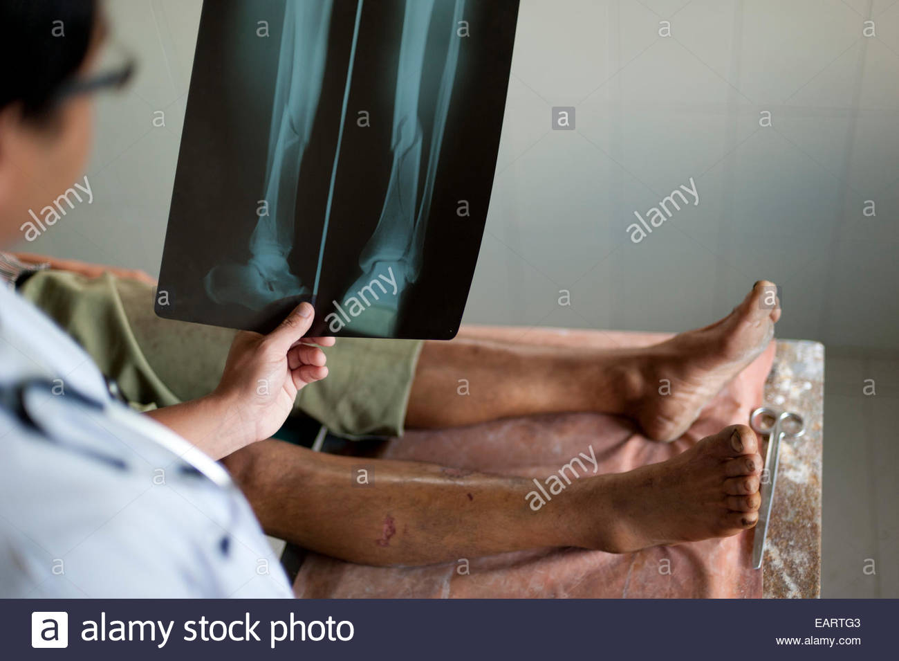 A Patient With A Leg Fracture Stock Photos & A Patient With A Leg ...