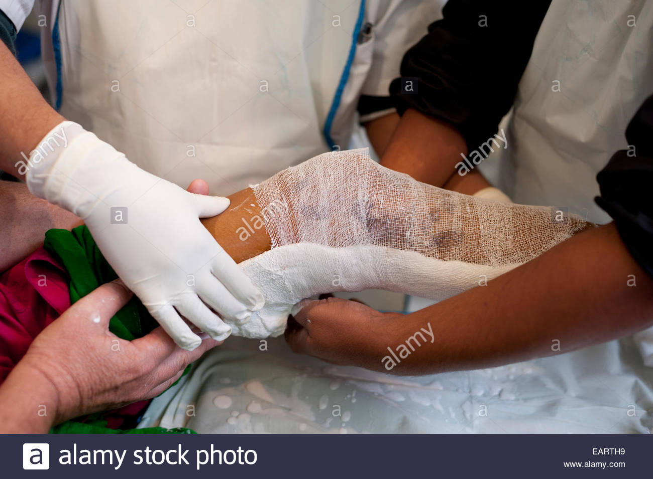 Hospital Plaster Cast Leg Stock Photos & Hospital Plaster Cast Leg ...