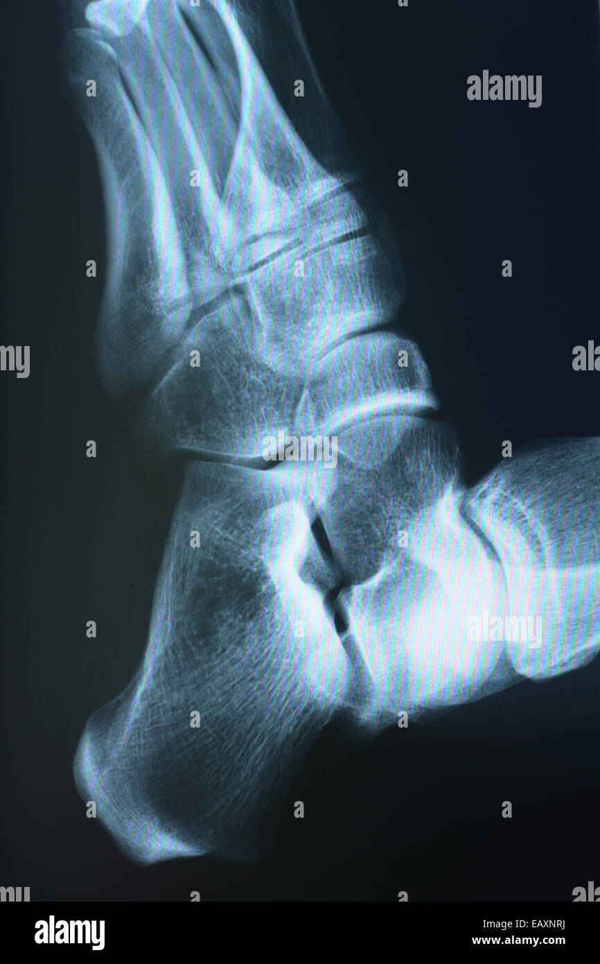 Right foot x ray hi-res stock photography and images - Alamy