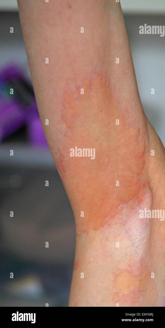 Nettle rash hi-res stock photography and images - Alamy