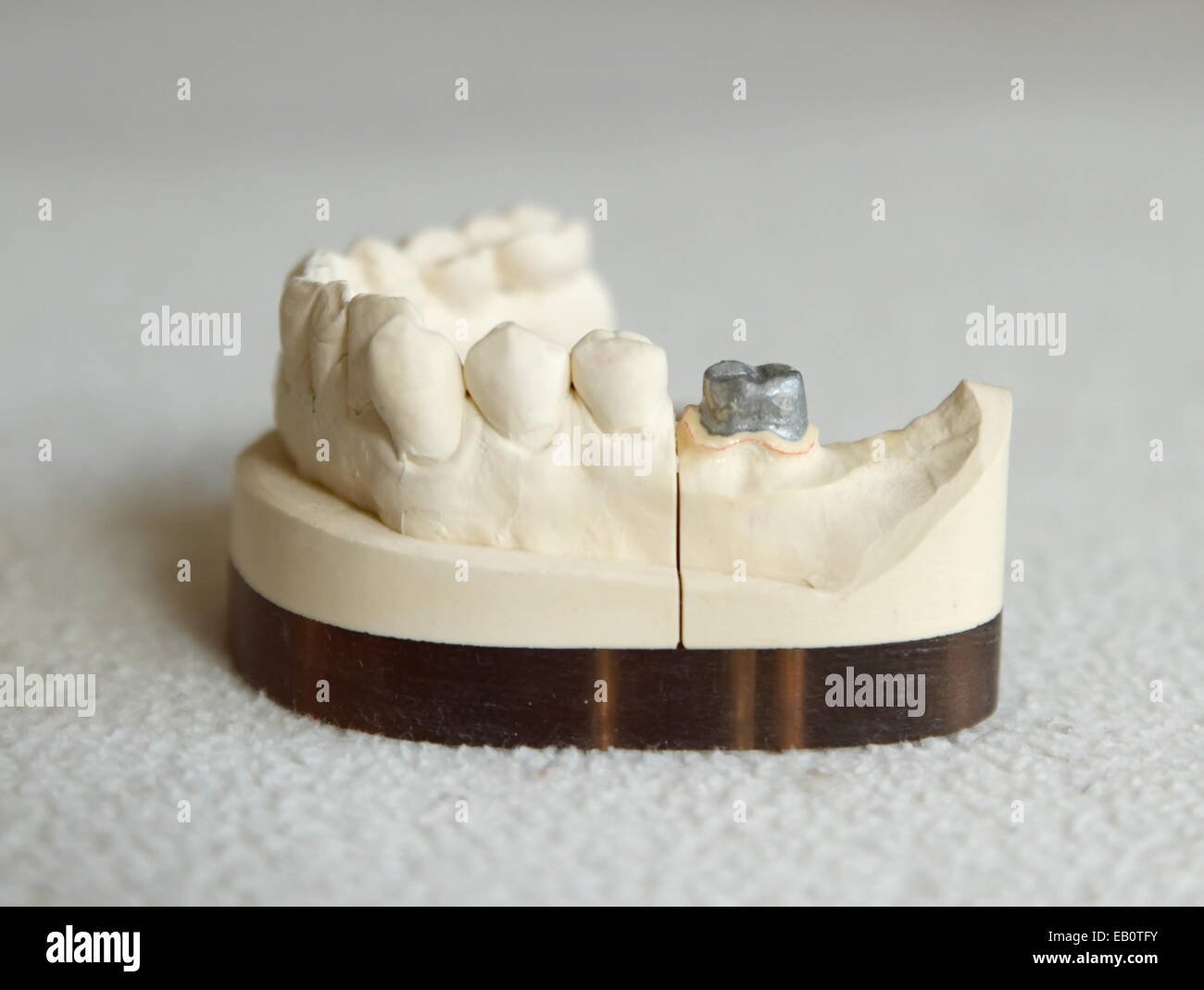 Zirconium or porcelain crown preparation on cast model Stock Photo - Alamy