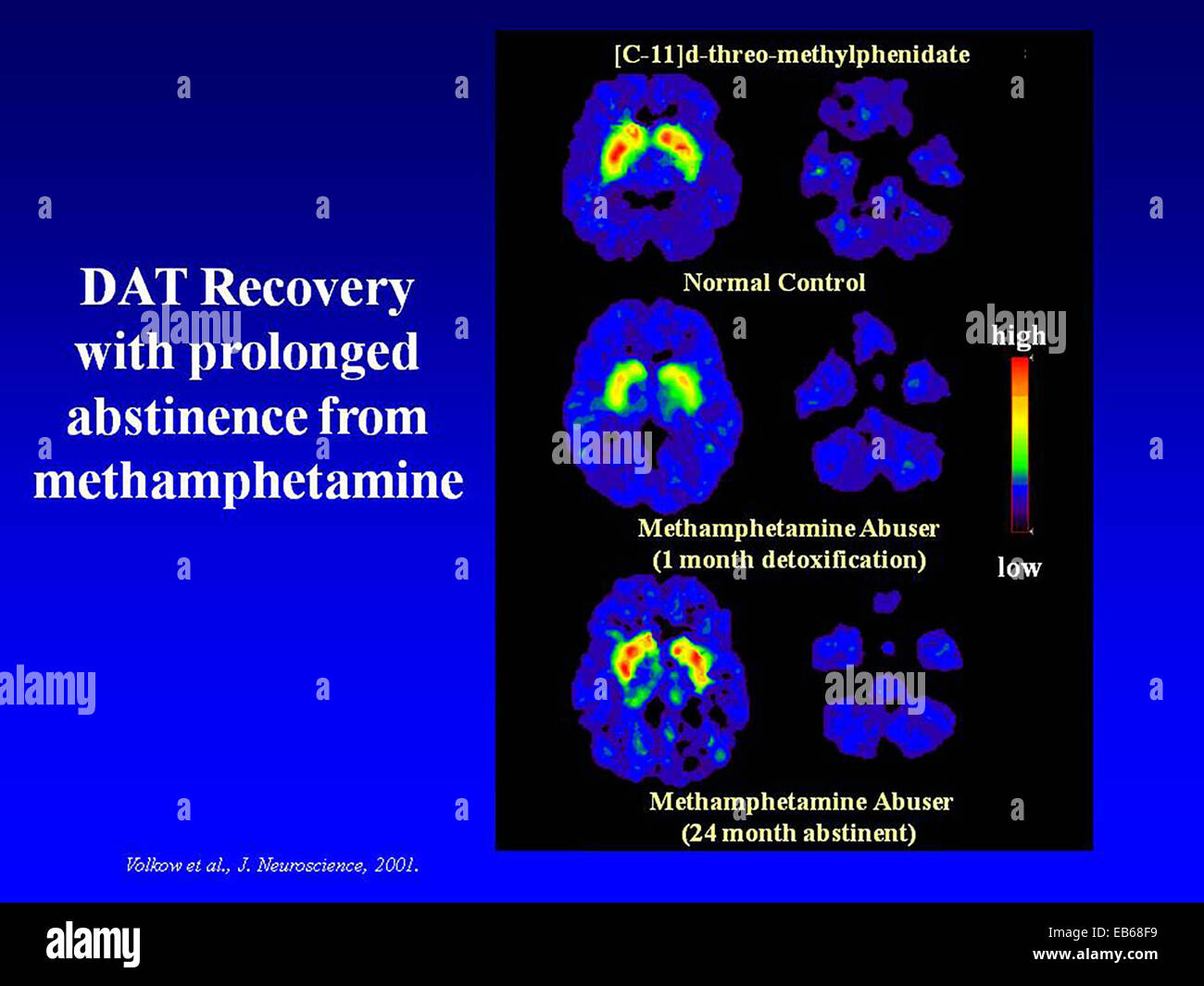 Dat brain scan hi-res stock photography and images - Alamy