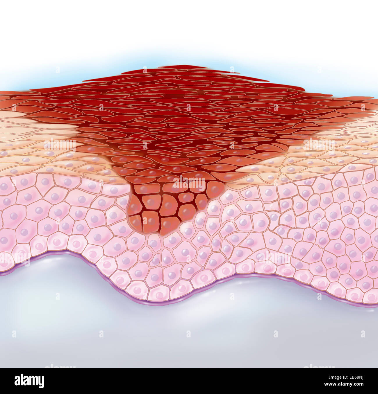 Melanoma hi-res stock photography and images - Alamy