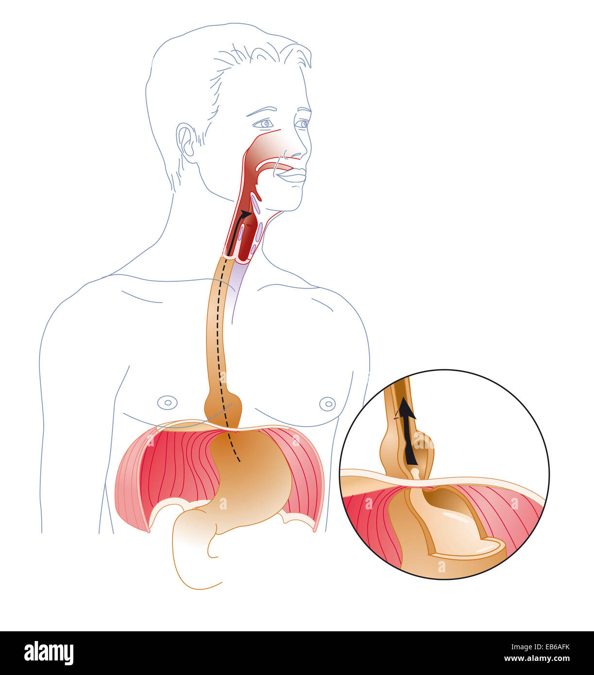HIATAL HERNIA, DRAWING Stock Photo - Alamy