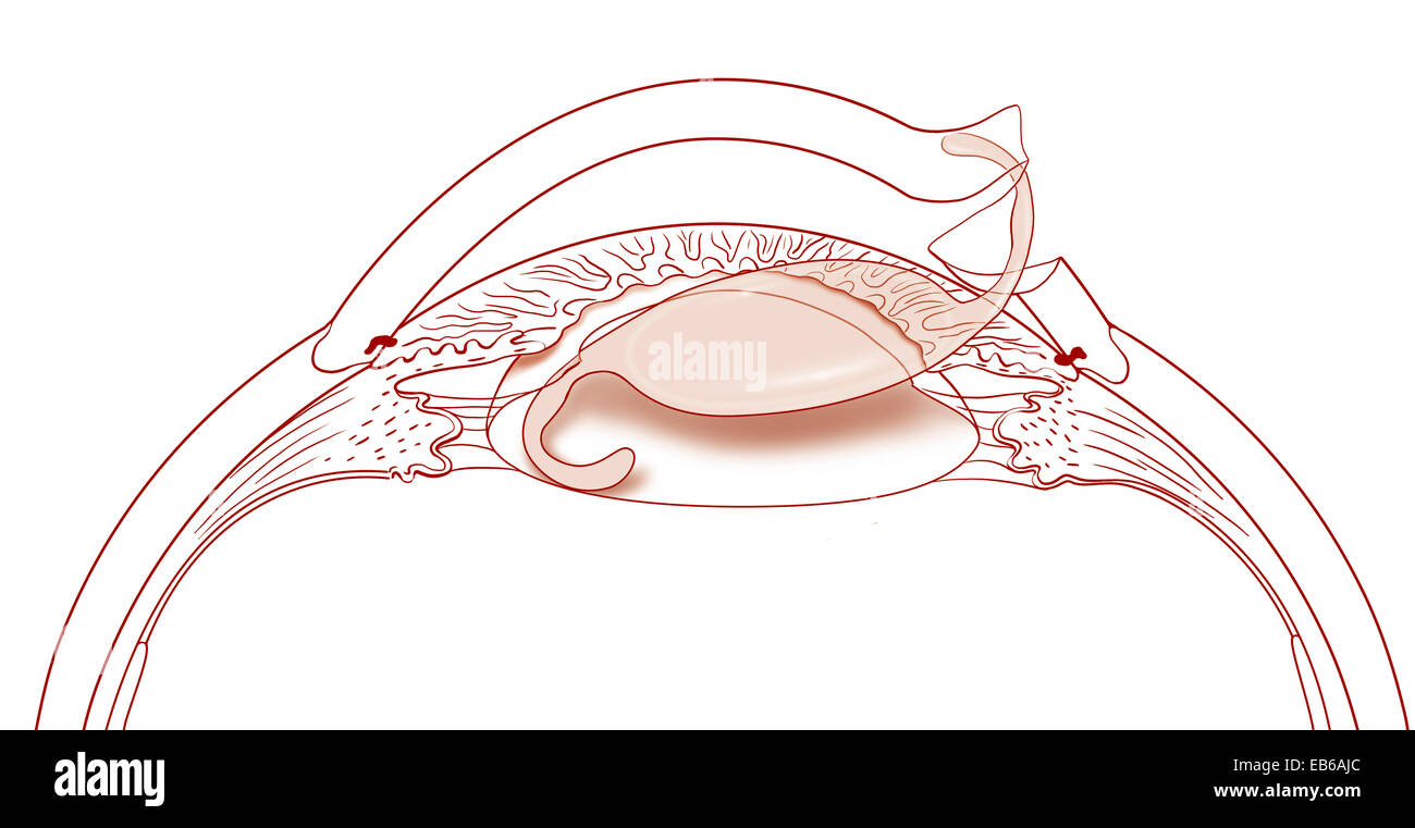 CATARACT SURGERY, DRAWING Stock Photo - Alamy