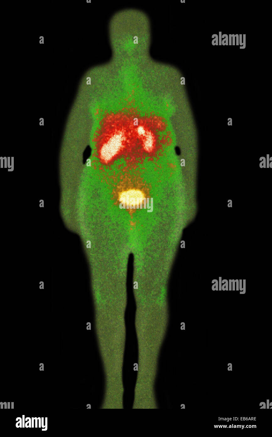 STOMACH CANCER, SCINTISCAN Stock Photo - Alamy