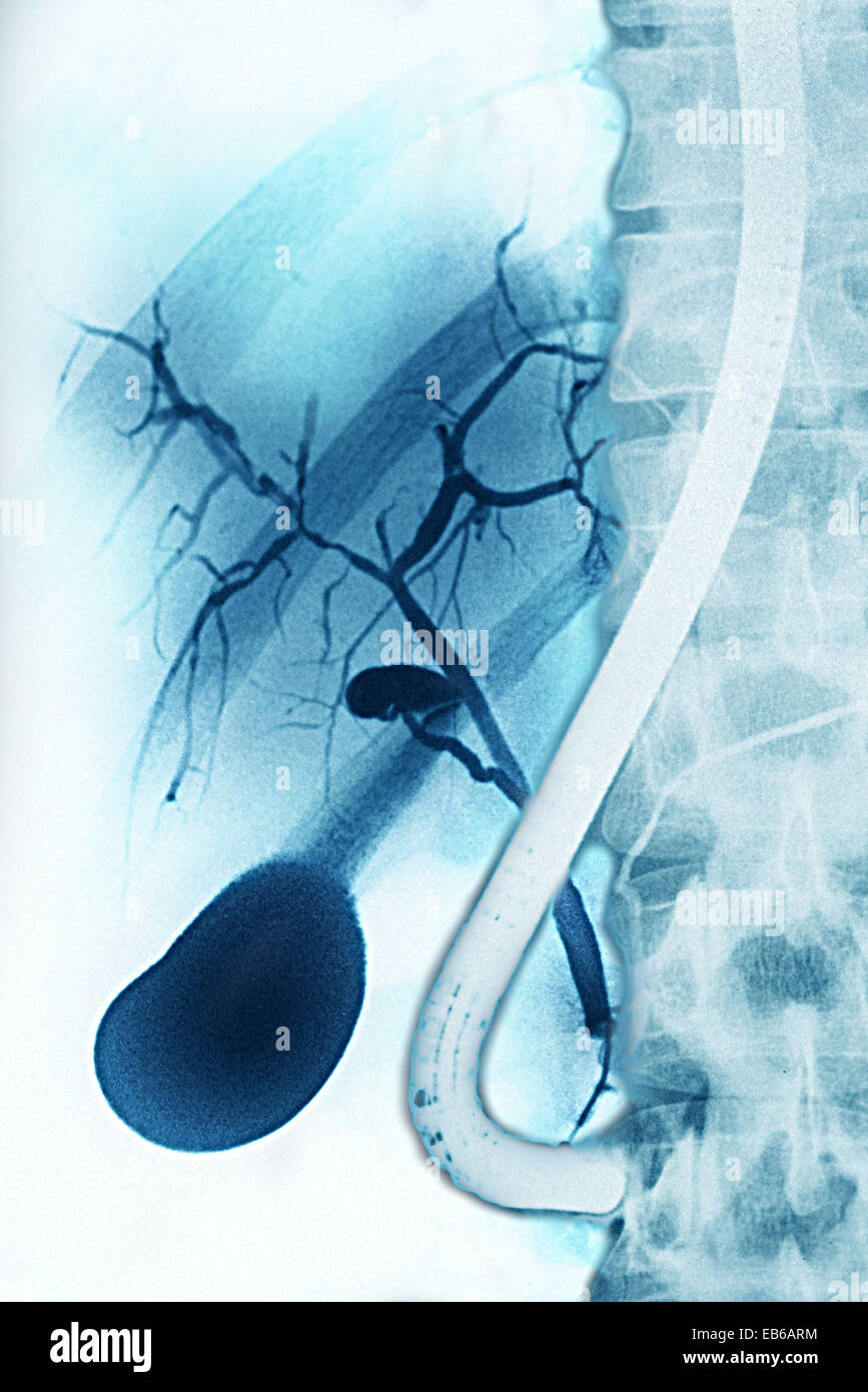 PRIMARY SCLEROSING CHOLANGITIS Stock Photo - Alamy