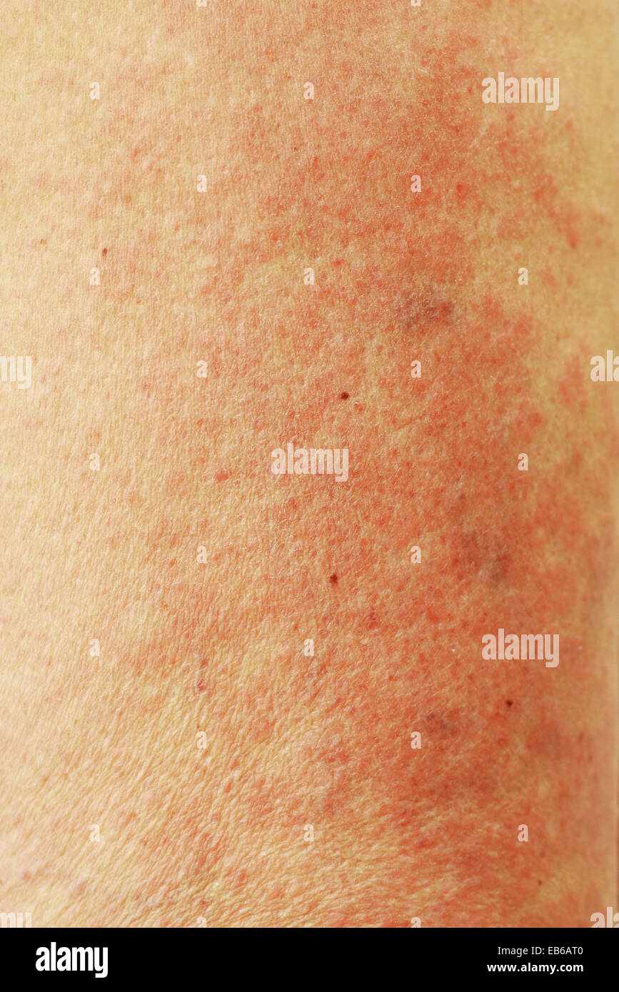 Dermatoses Stock Photos & Dermatoses Stock Images - Alamy