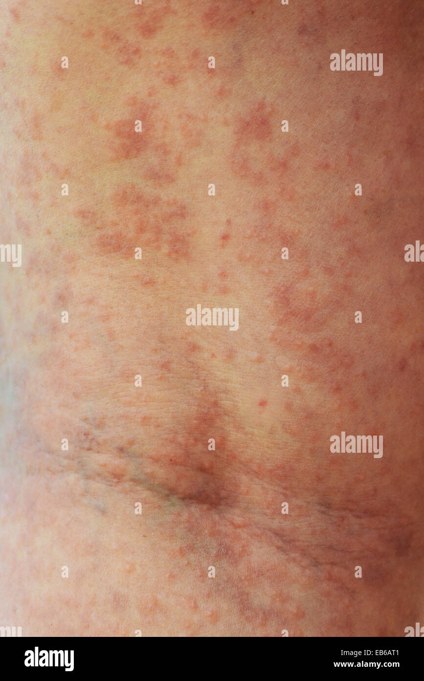 Erythema hi-res stock photography and images - Alamy