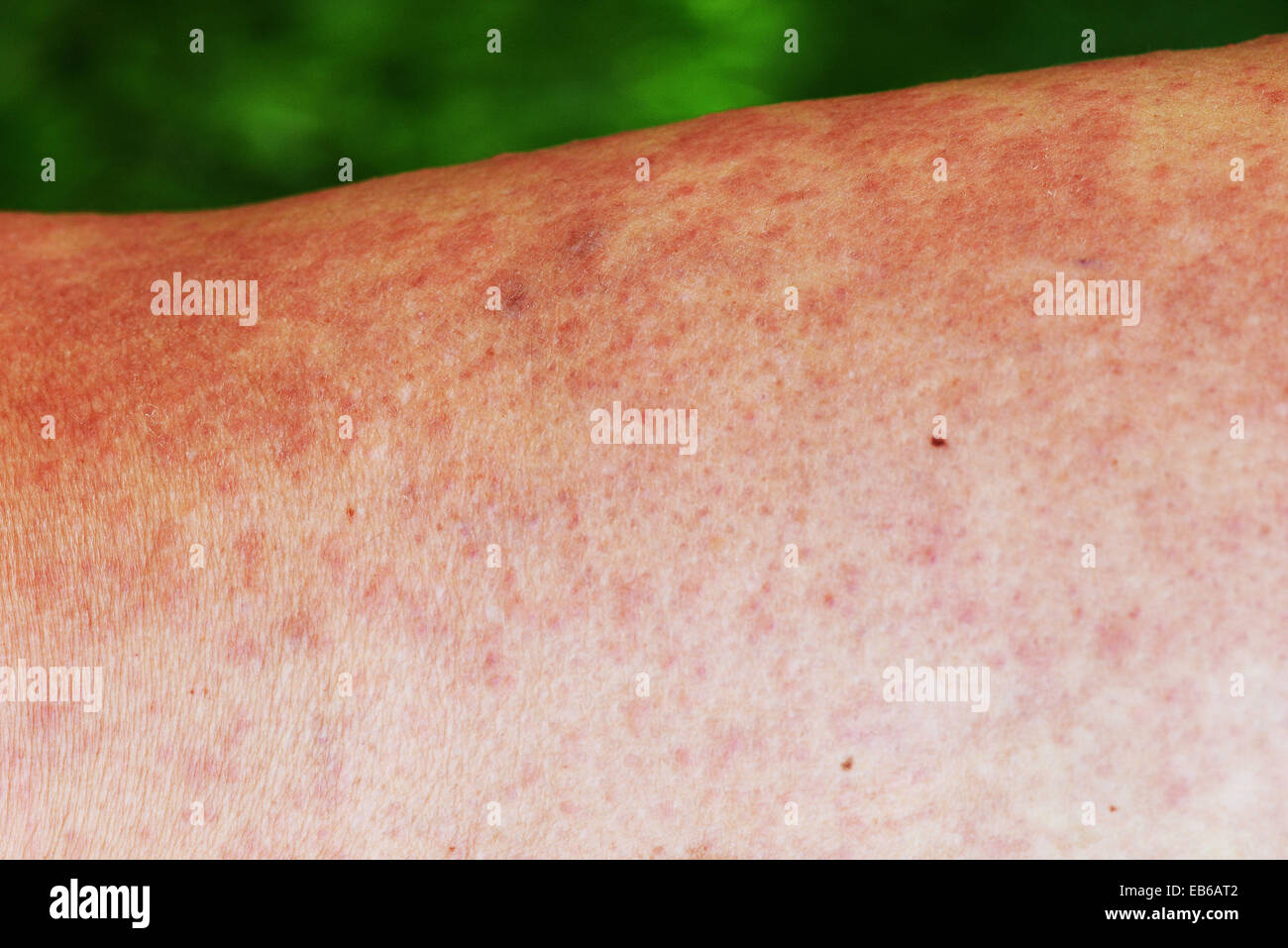 Erythema hi-res stock photography and images - Alamy