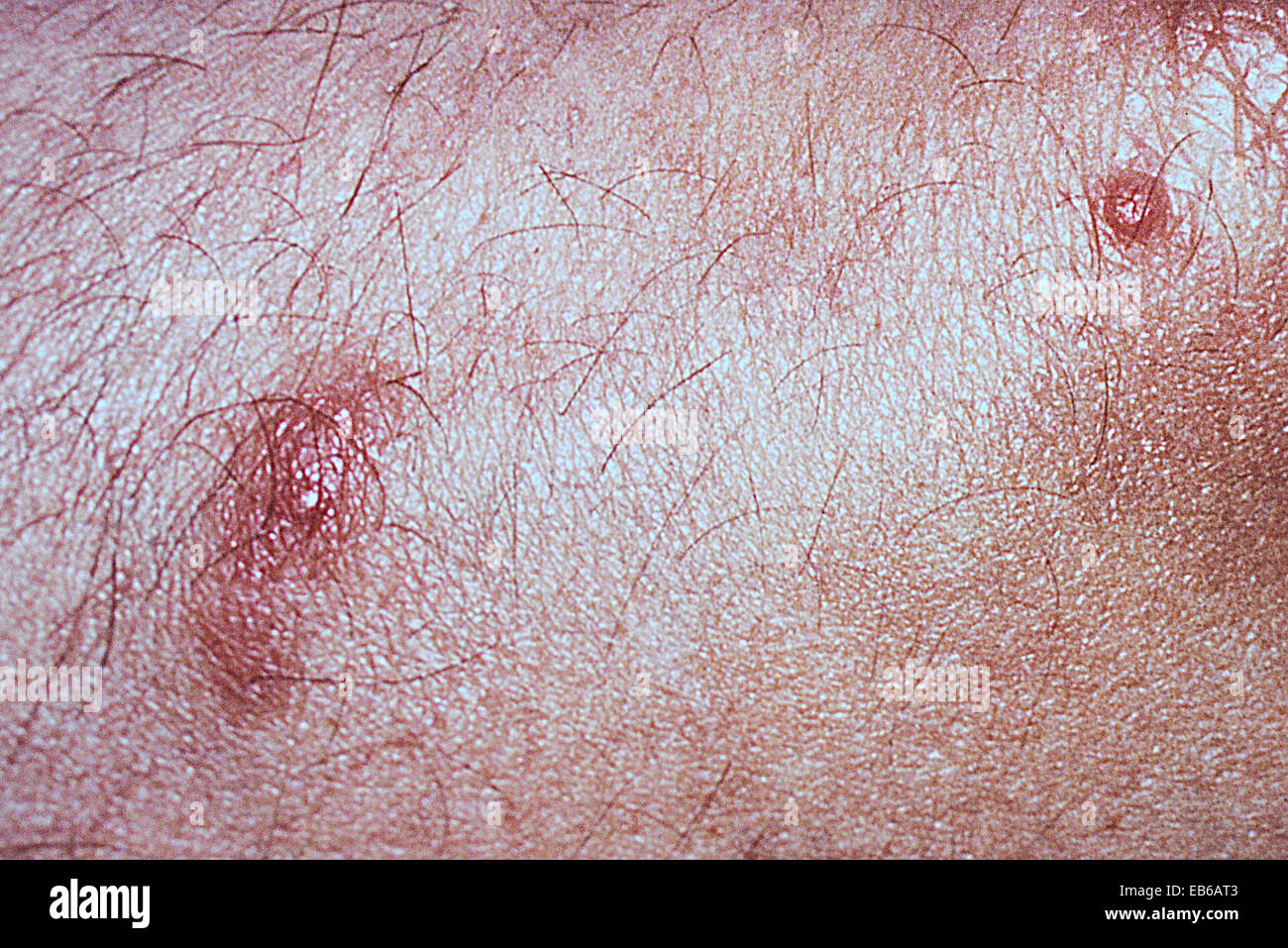 Pustules High Resolution Stock Photography and Images - Alamy