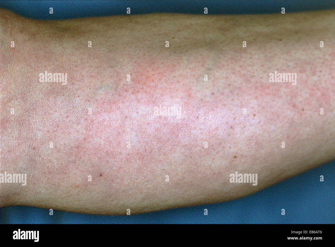 Livedo hi-res stock photography and images - Alamy