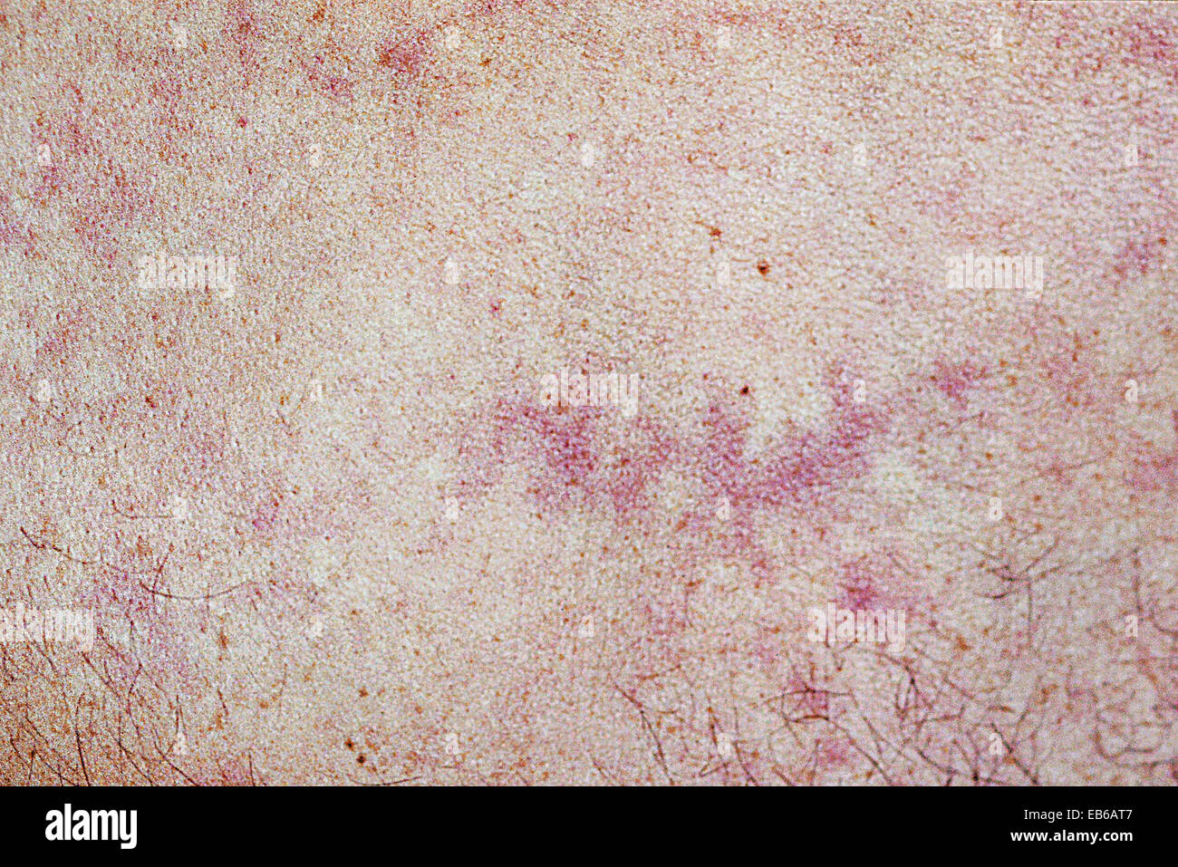 Livedo hi-res stock photography and images - Alamy