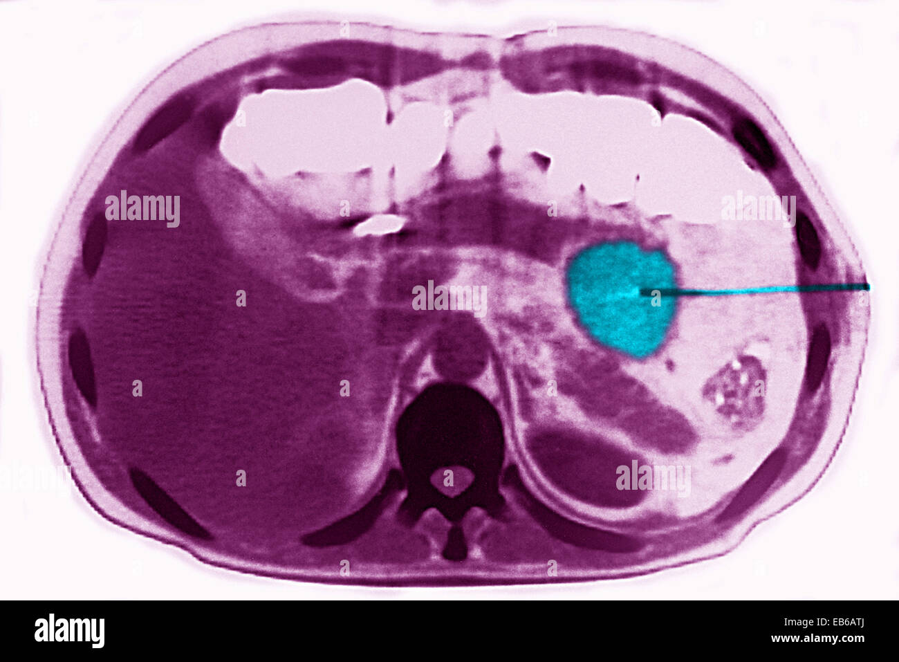 Cyst removal hi-res stock photography and images - Alamy