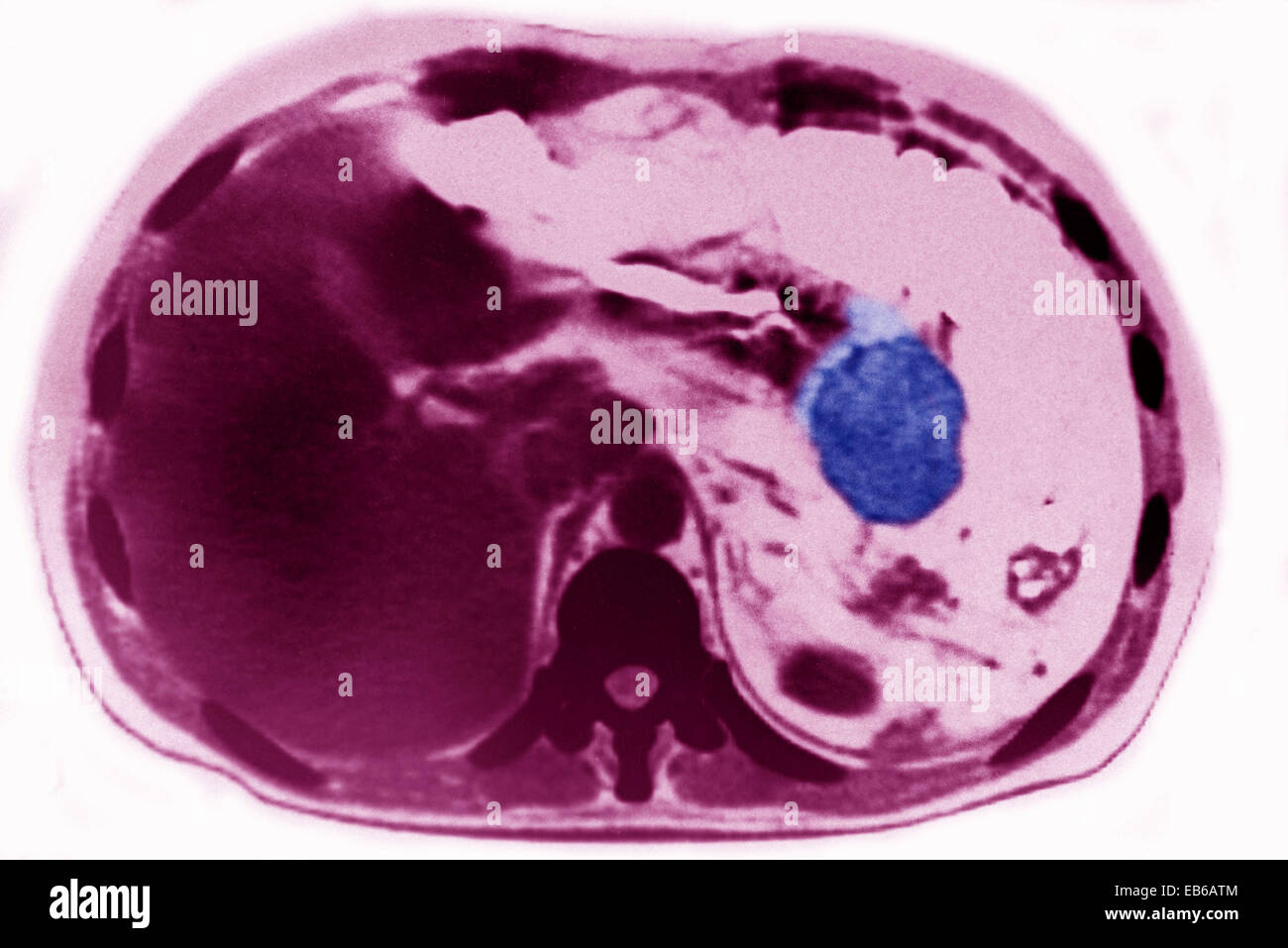 PANCREATIC CYST, CT SCAN Stock Photo - Alamy