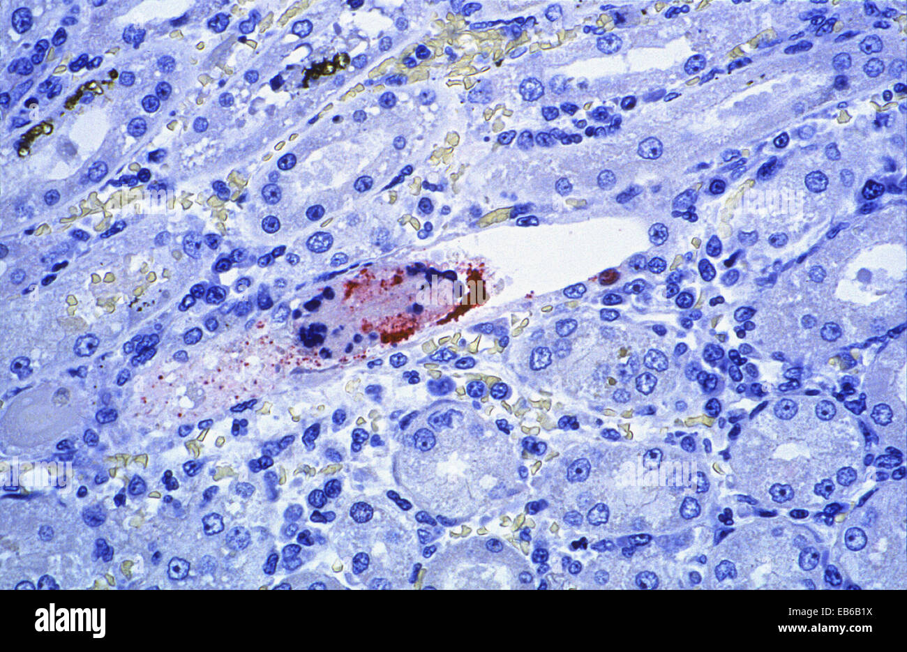 NIPAH VIRUS INFECTION Stock Photo - Alamy