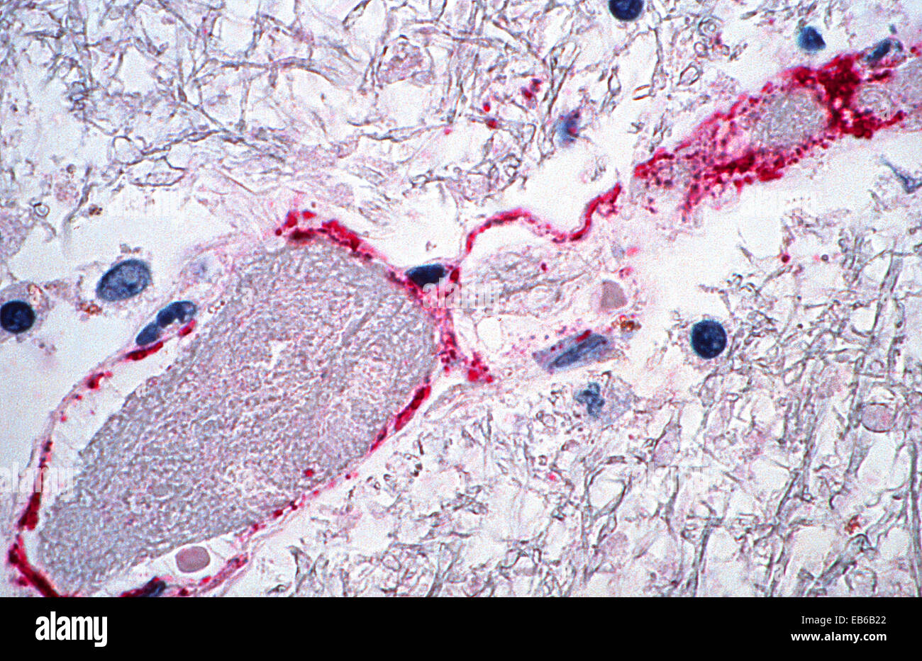 NIPAH VIRUS INFECTION Stock Photo - Alamy