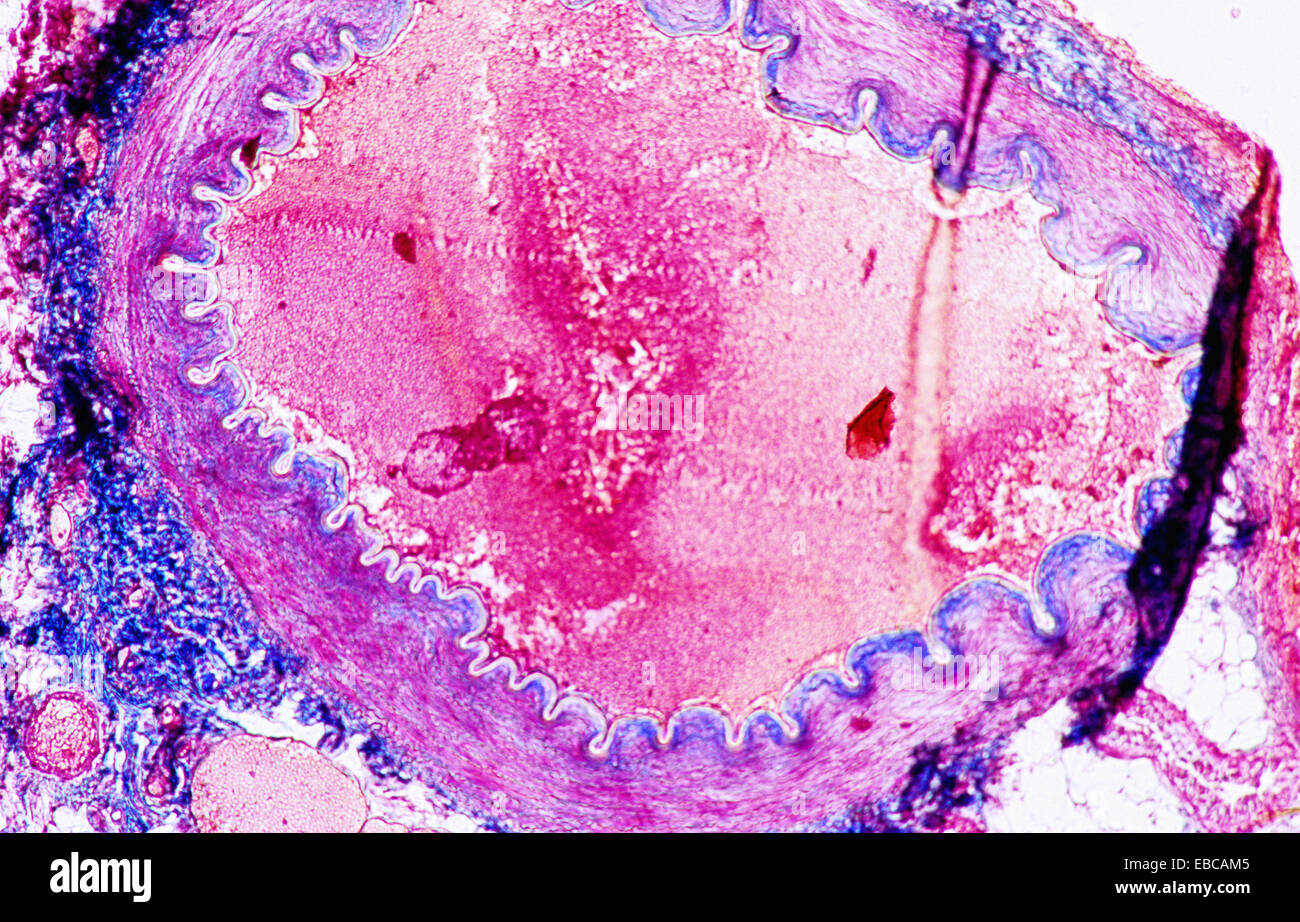 Atherosclerotic Stock Photos & Atherosclerotic Stock Images - Alamy