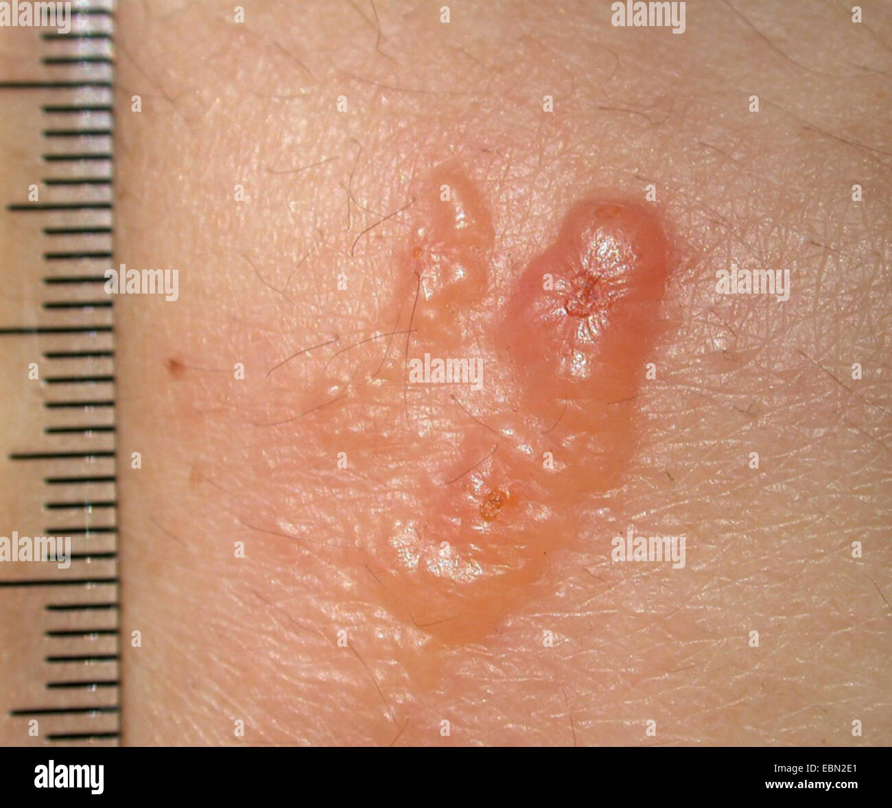 poison ivy, eastern poison-ivy, poison oak (Rhus radicans ...