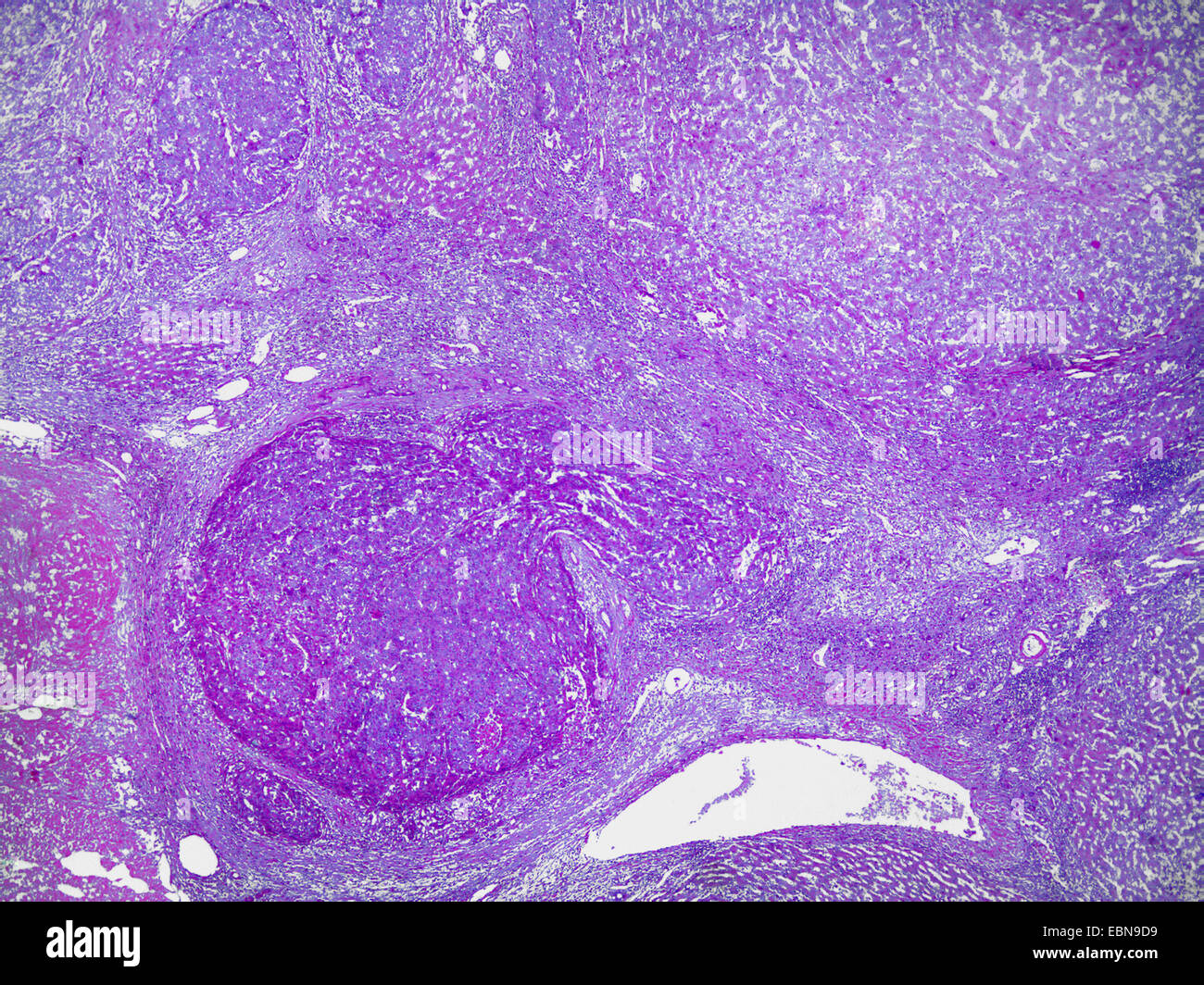 primary hepatic cancer, microscopical section, 40 x Stock Photo - Alamy