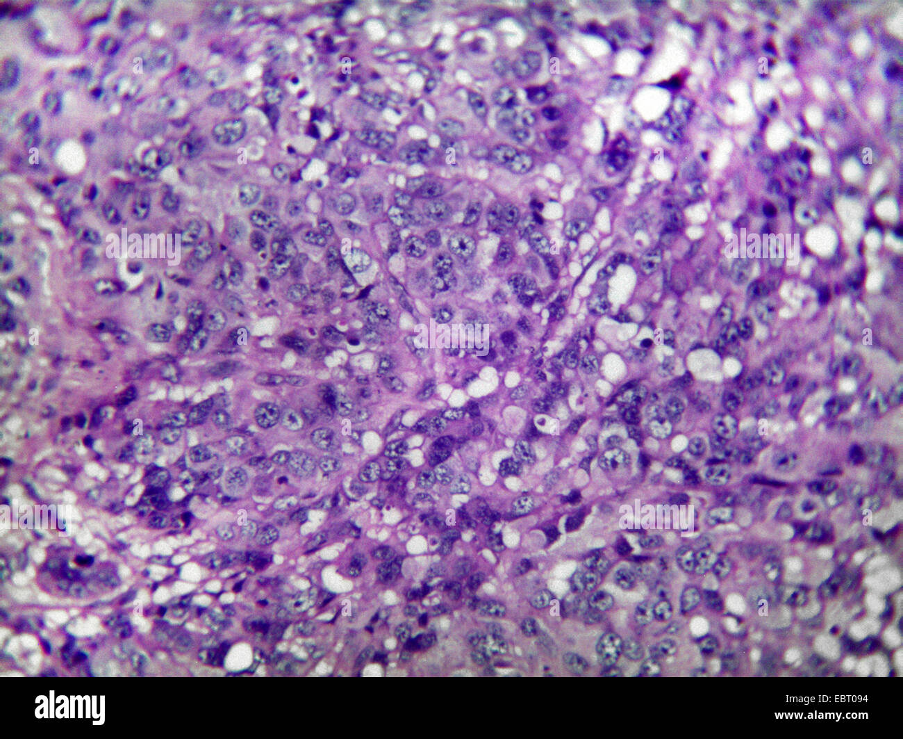 dermal cancer, 400 x Stock Photo - Alamy