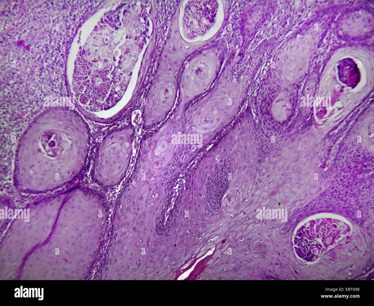 Skin with squamous cell carcinoma hi-res stock photography and images ...