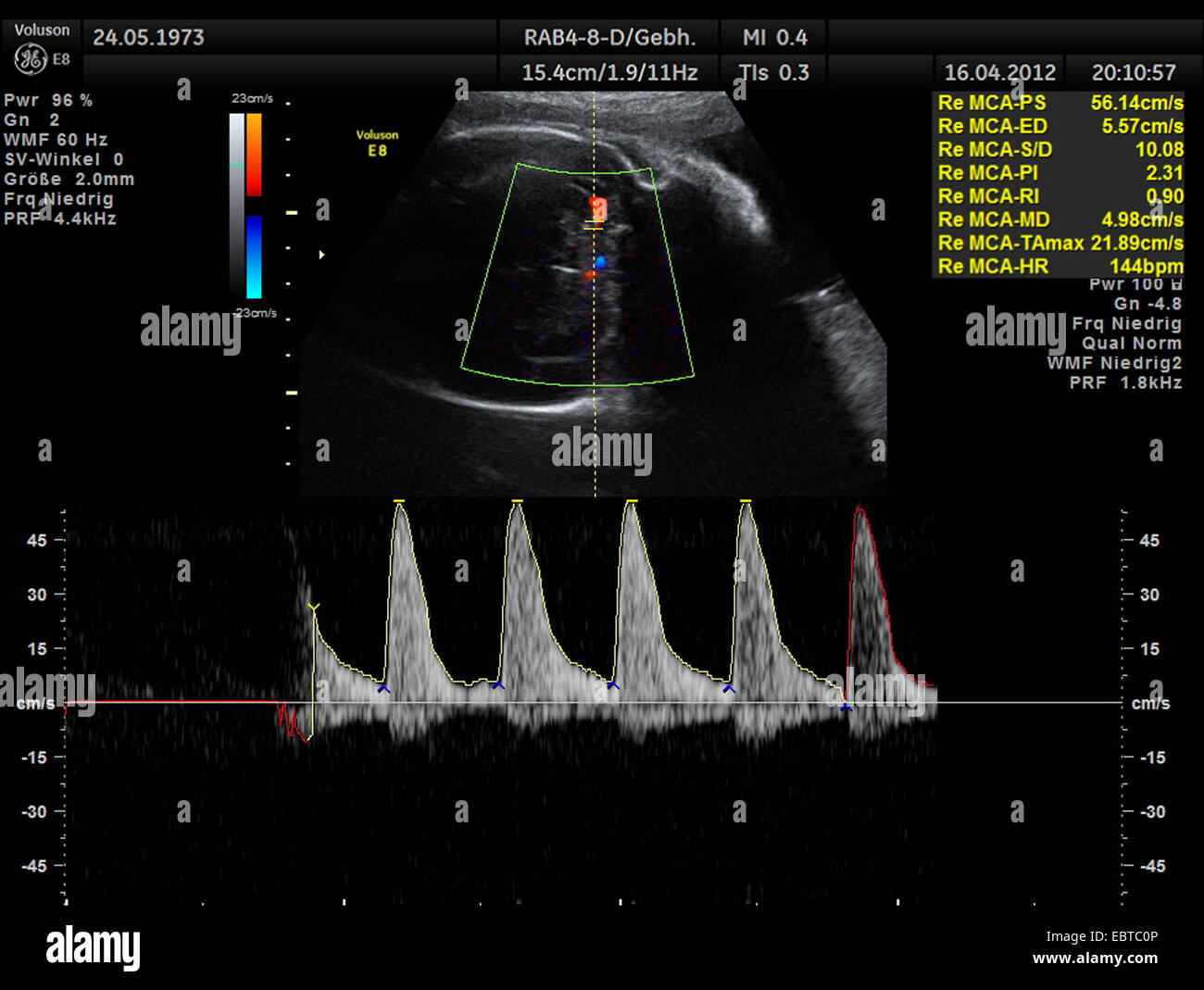 sonogram of the head of an embryo in the womb with heart tone diagram ...