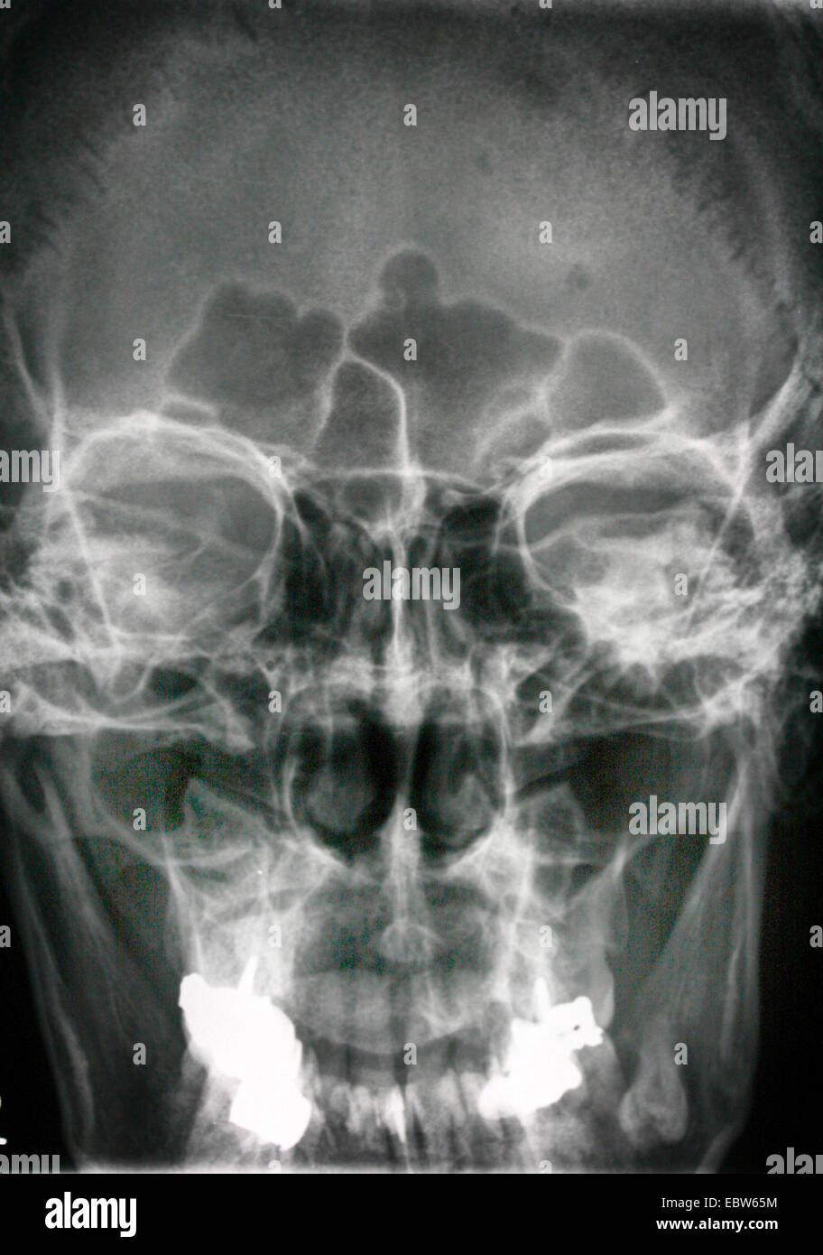 people, human beings, humans (Homo sapiens sapiens), X-ray of the human ...