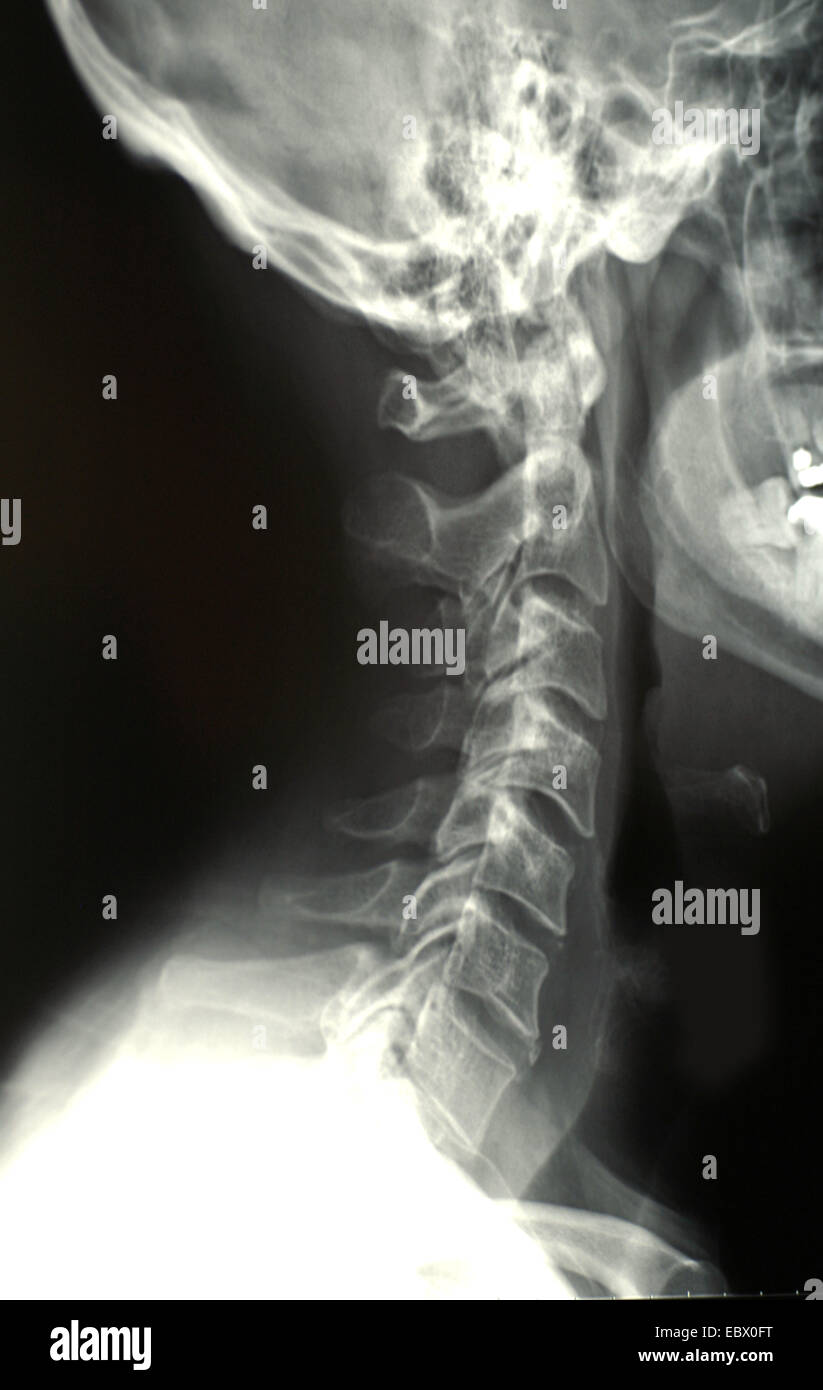 x-ray picture of a neck backbone Stock Photo - Alamy