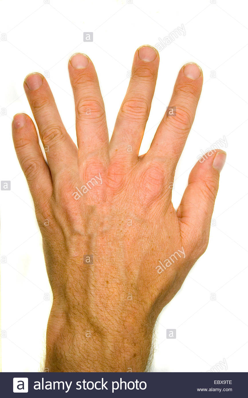 Polydactyly High Resolution Stock Photography and Images - Alamy